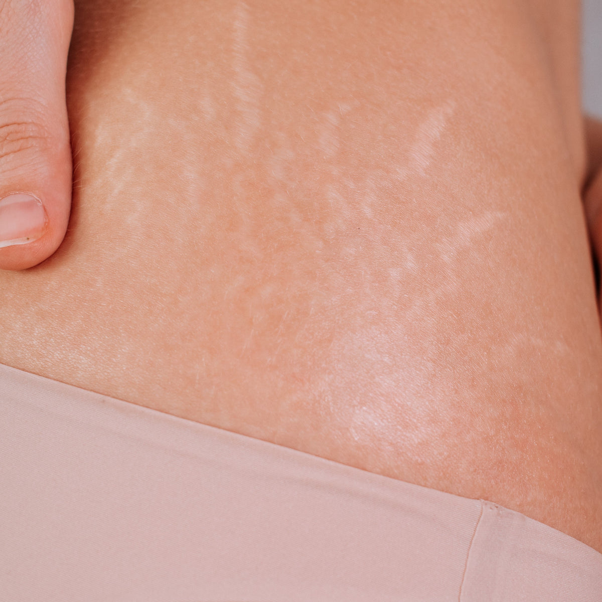 The Science Behind Stretch Mark Creams – Valeome