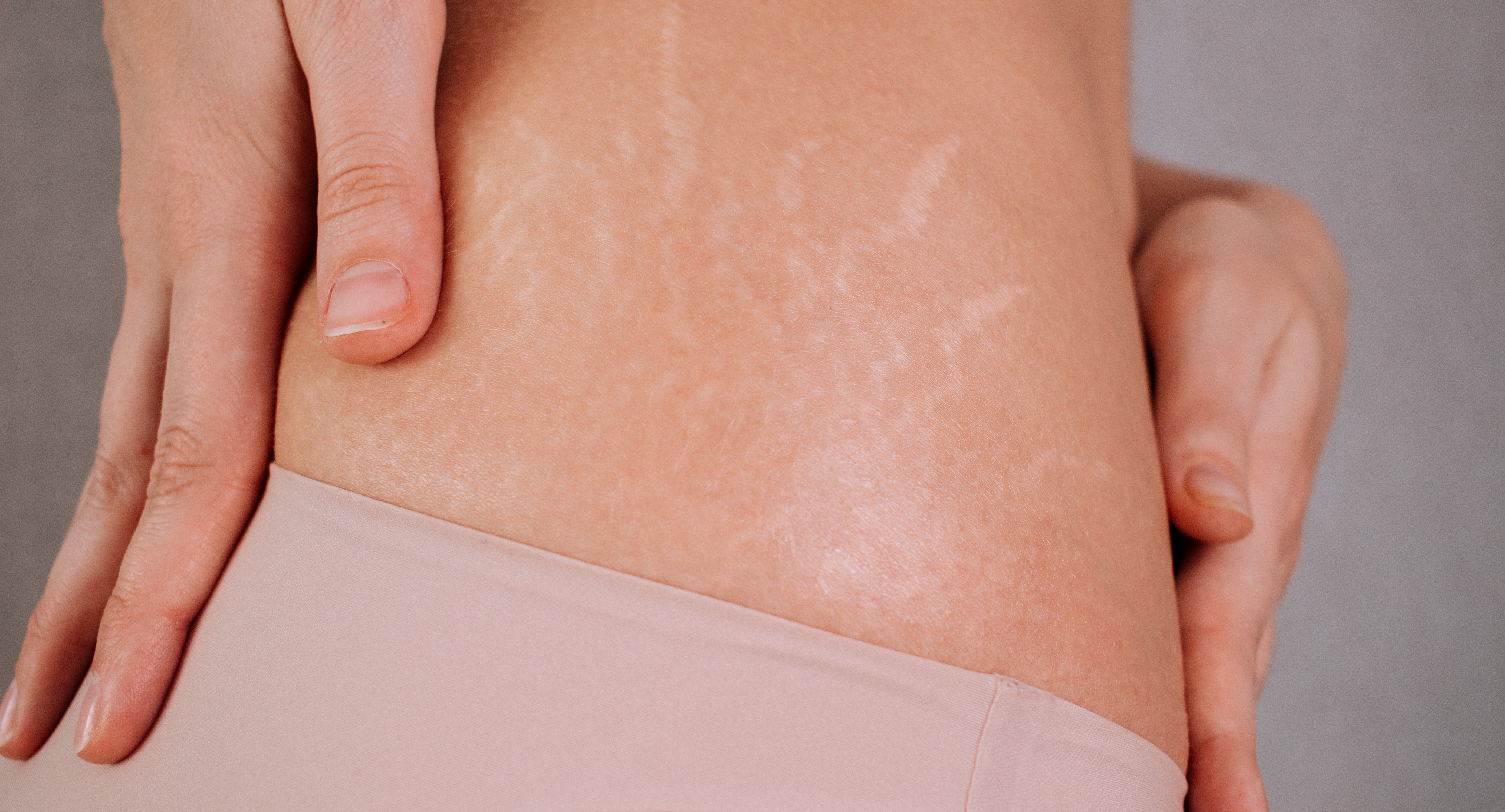 The Science Behind Stretch Mark Creams – Valeome